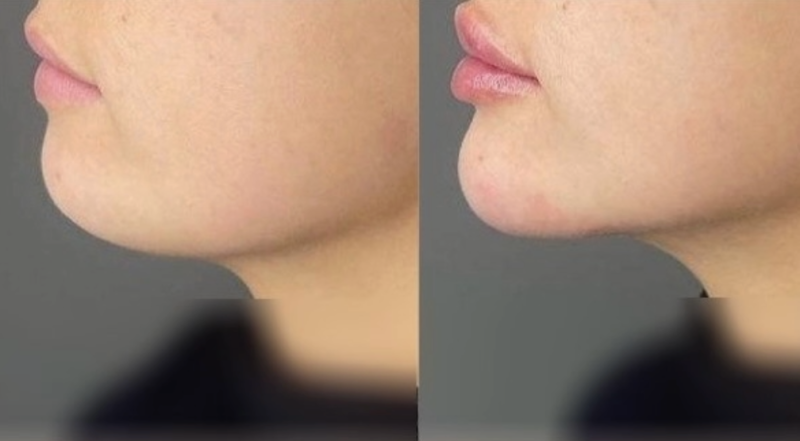 Sculptiva SHAPE Lido 1mL x 1 syr - Reju Pharma - Korean Aesthetic Shop